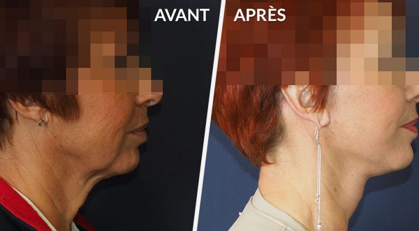 Lifting visage Archives - Dr Charambros Georgiou, Bastia