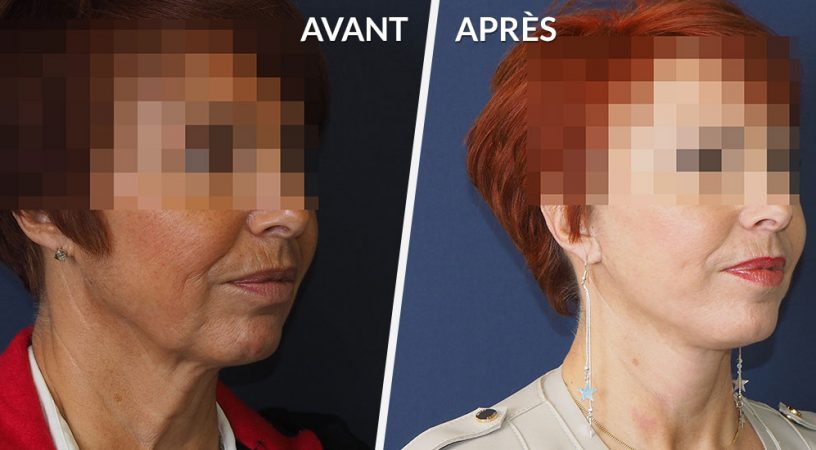 Lifting visage Archives - Dr Charambros Georgiou, Bastia